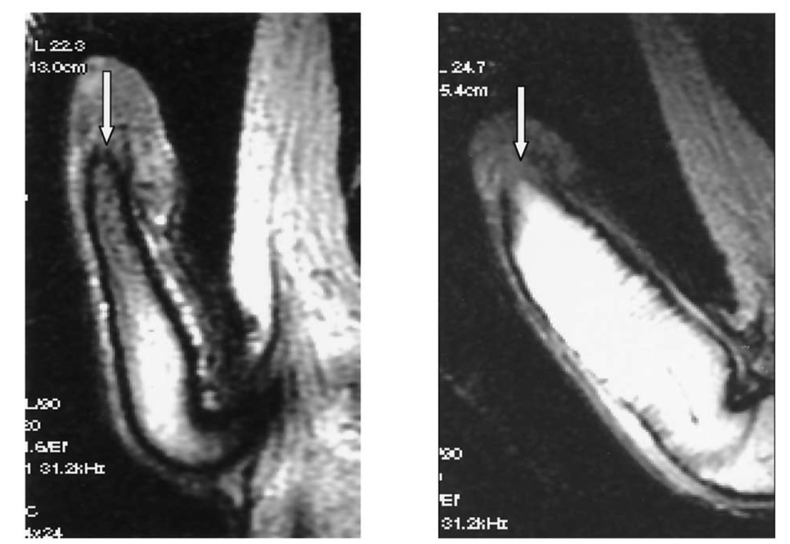 MAGNET AND THE PENILE CANCER:- Role of MRI in Penile cancer - Dr ...